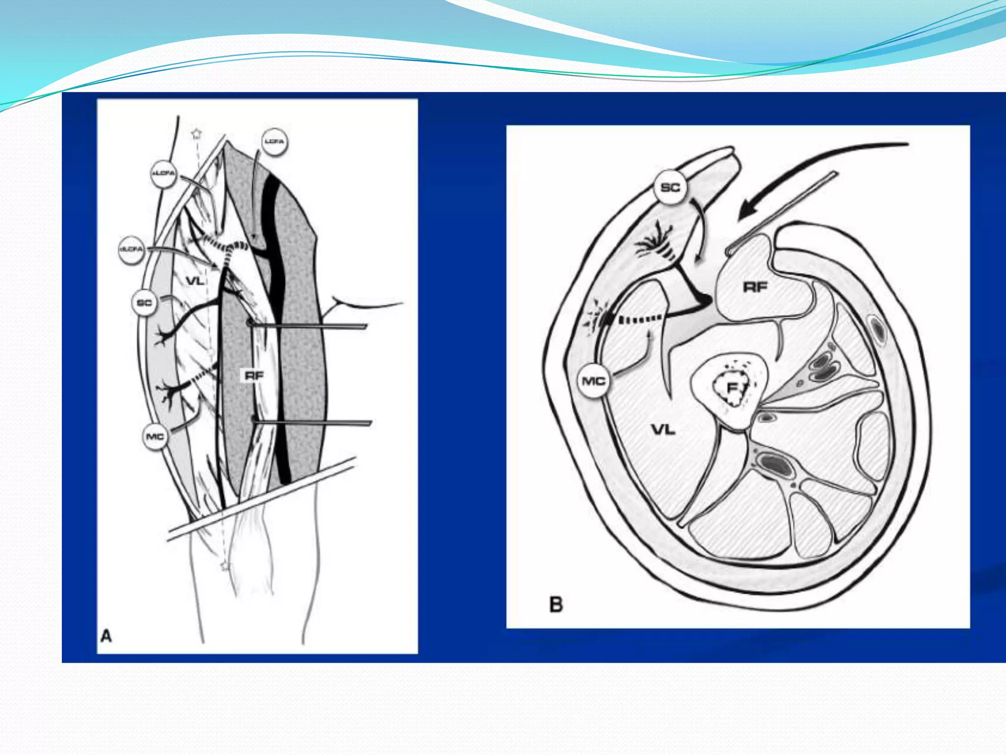 Anterolateral thigh flap | PPTX