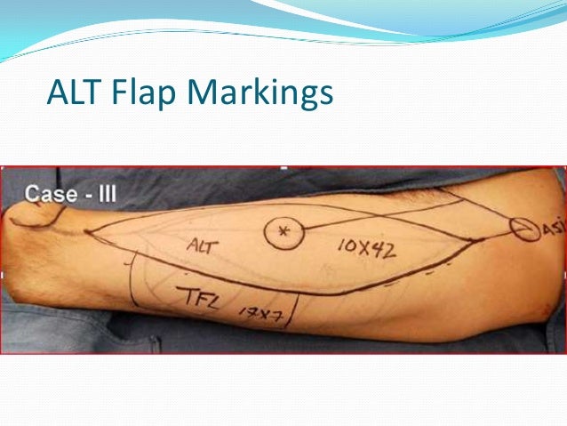Anterolateral thigh flap