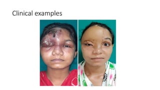 ALT flap presentation.pptx