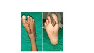 ALT flap presentation.pptx