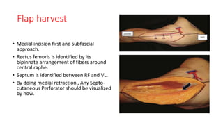 ALT flap presentation.pptx