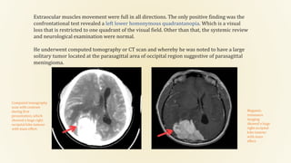 Altitudinal Visual Field Defect.pptx