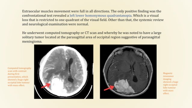Altitudinal Visual Field Defect.pptx