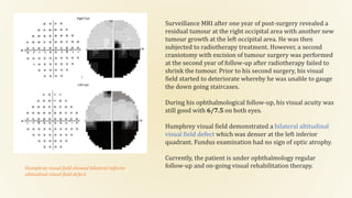 Altitudinal Visual Field Defect.pptx