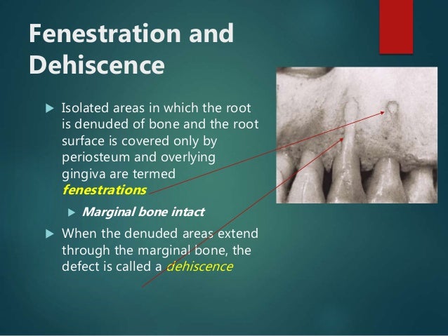 Alveolar bone
