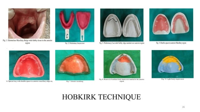 ALVEOLAR BONE and residual ridge resorption.pptx
