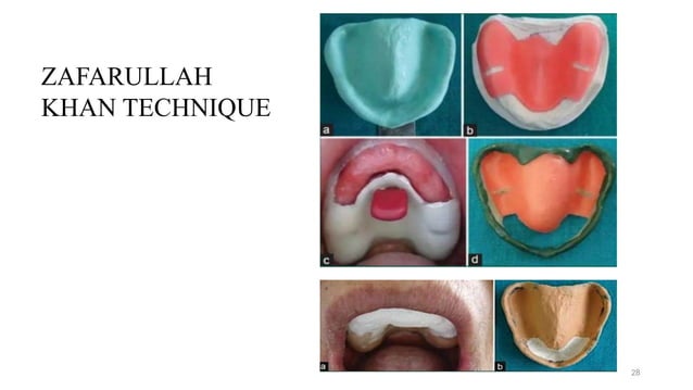 ALVEOLAR BONE and residual ridge resorption.pptx