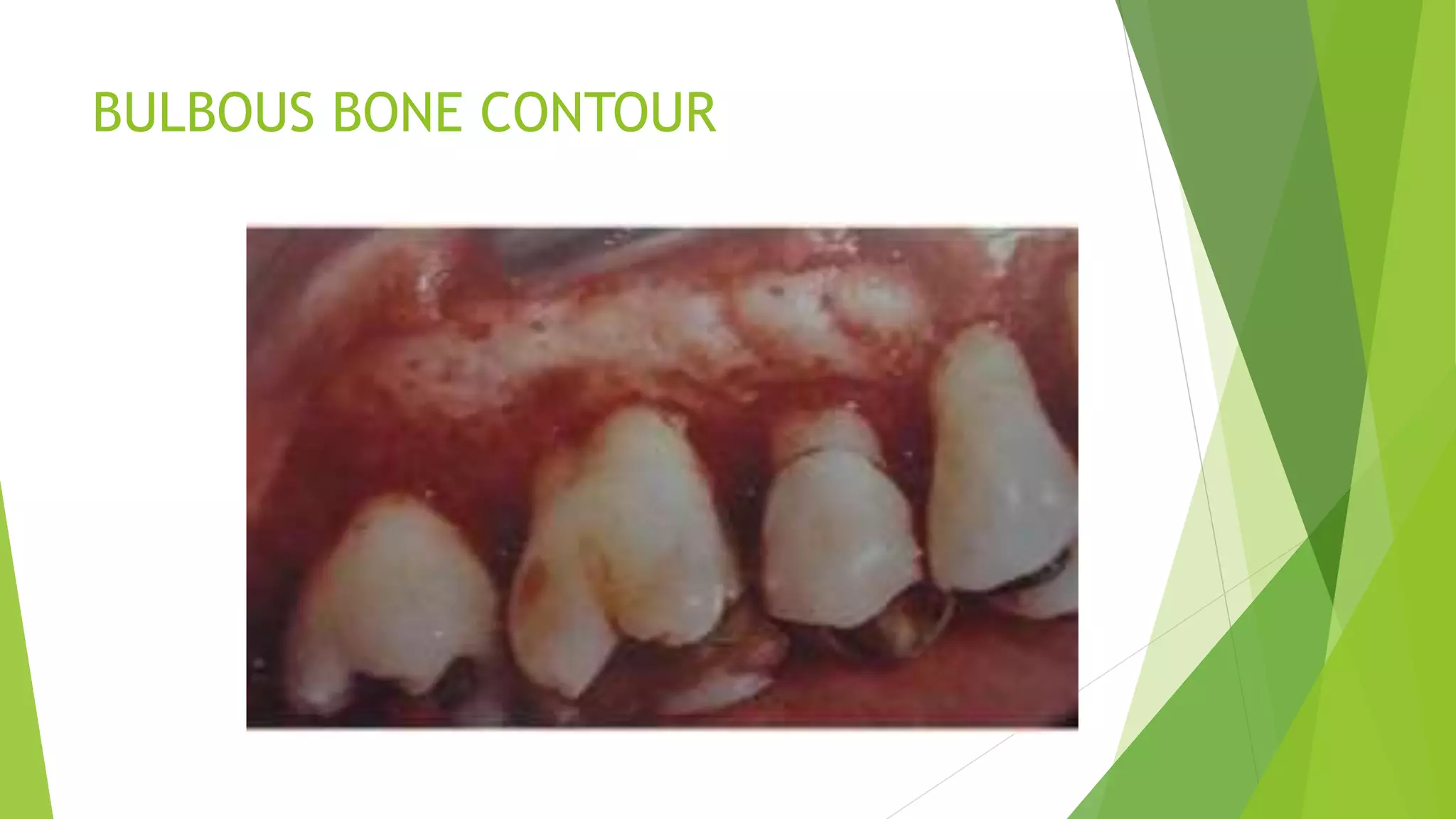 ALVEOLAR BONE-Dr.Mary Joseph.pptx