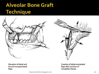 Alveolar Bone Graft