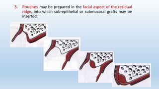 Alveolar bone in prosthodontics | PPTX
