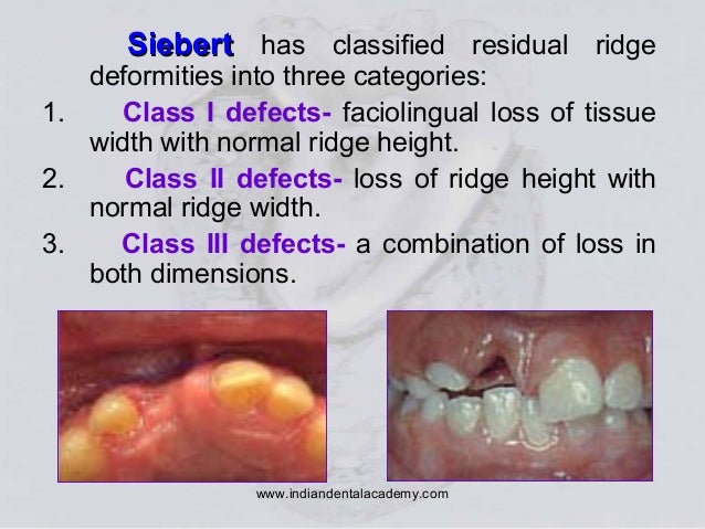 Alveolar bone and its relavance in prosthodontics / dental courses