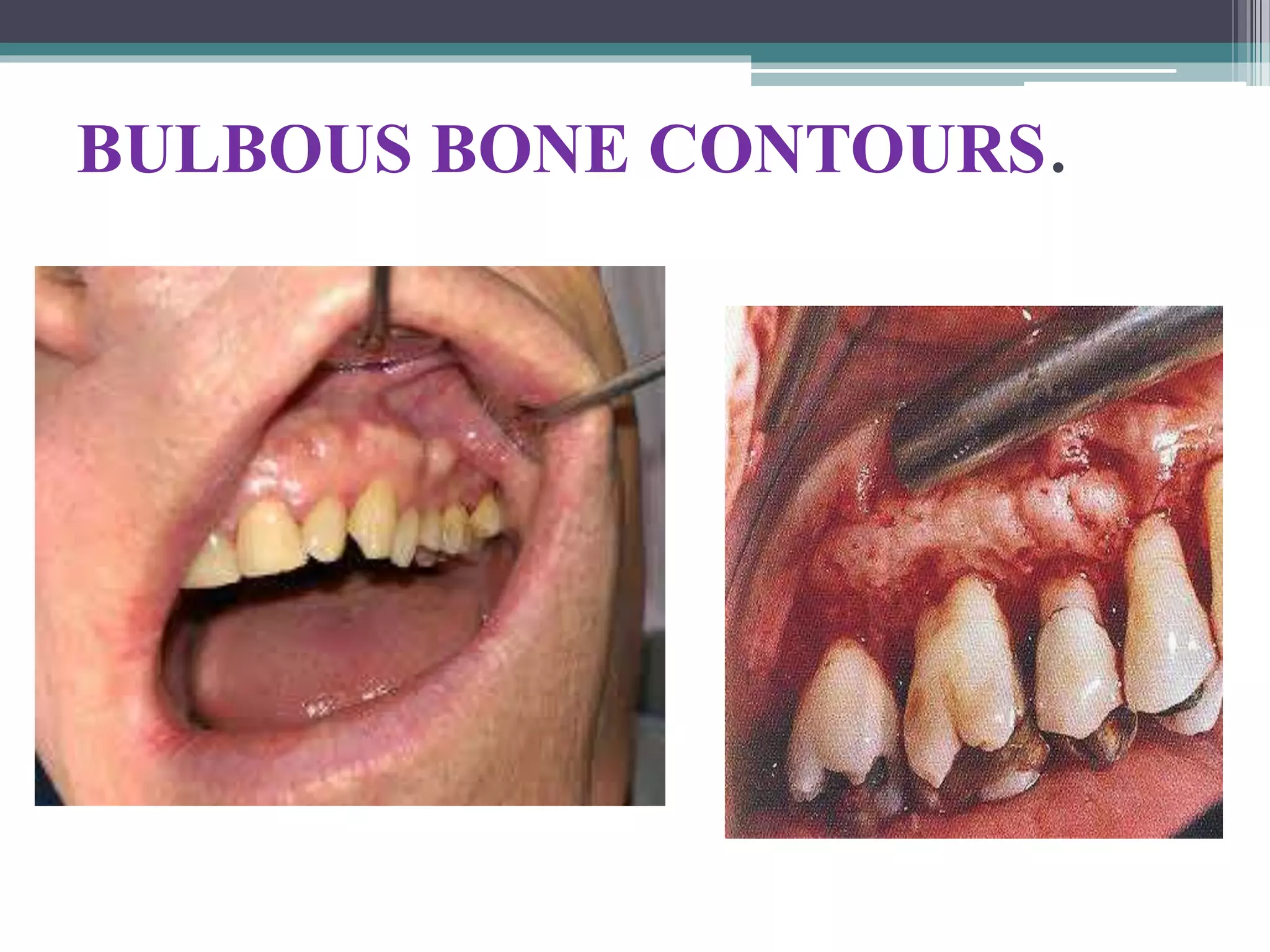 Alveolar bone ppt | PPTX