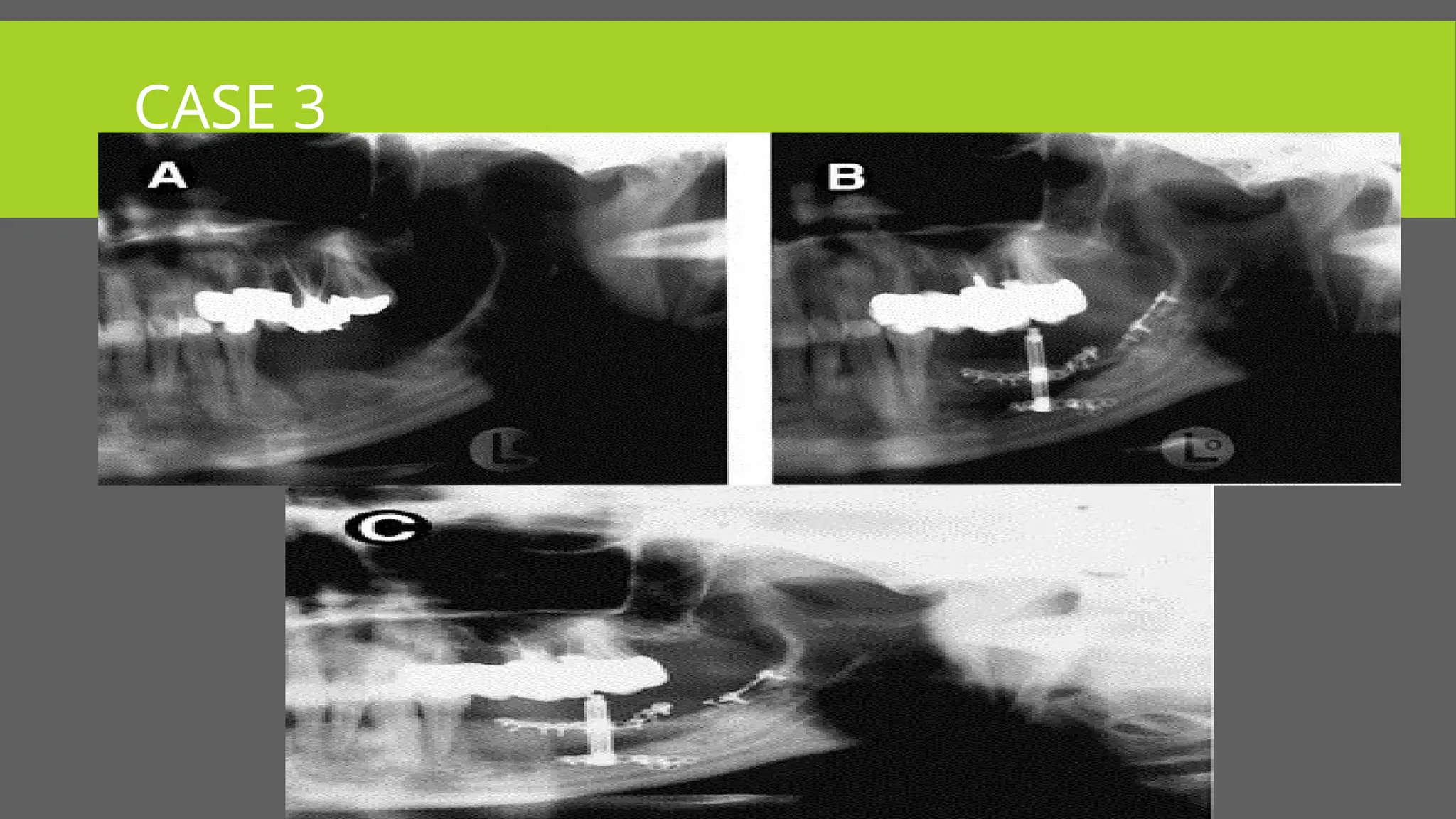 Alveolar distraction - oral & maxillofacial surgery .pptx