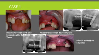 Alveolar distraction - oral & maxillofacial surgery .pptx