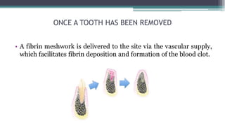 Alveolar osteitis - DIKIOHS DUHS | PPTX | Dental Health | Diseases and ...
