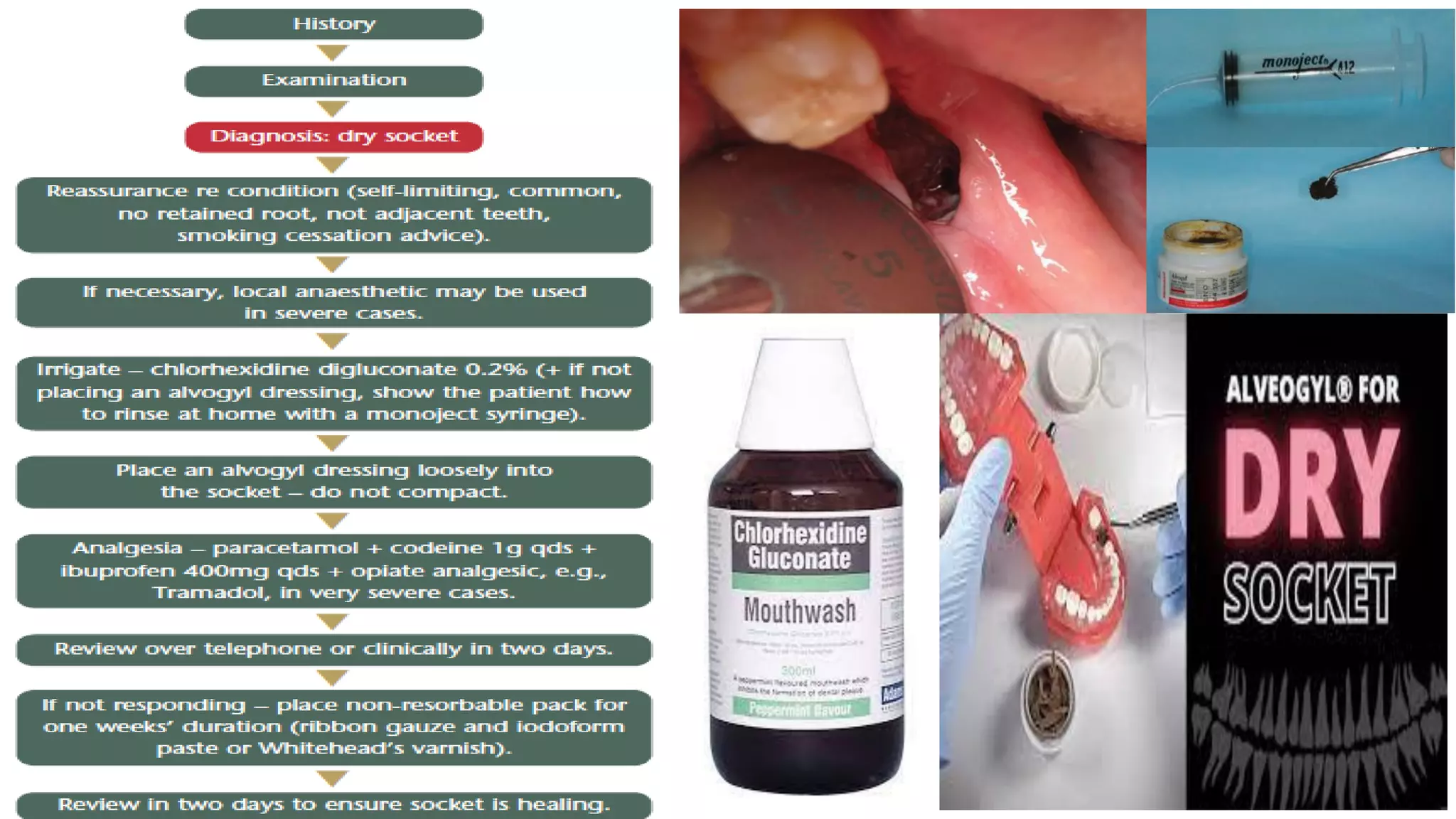 Alveolar Osteitis-DRY SOCKET .pdf