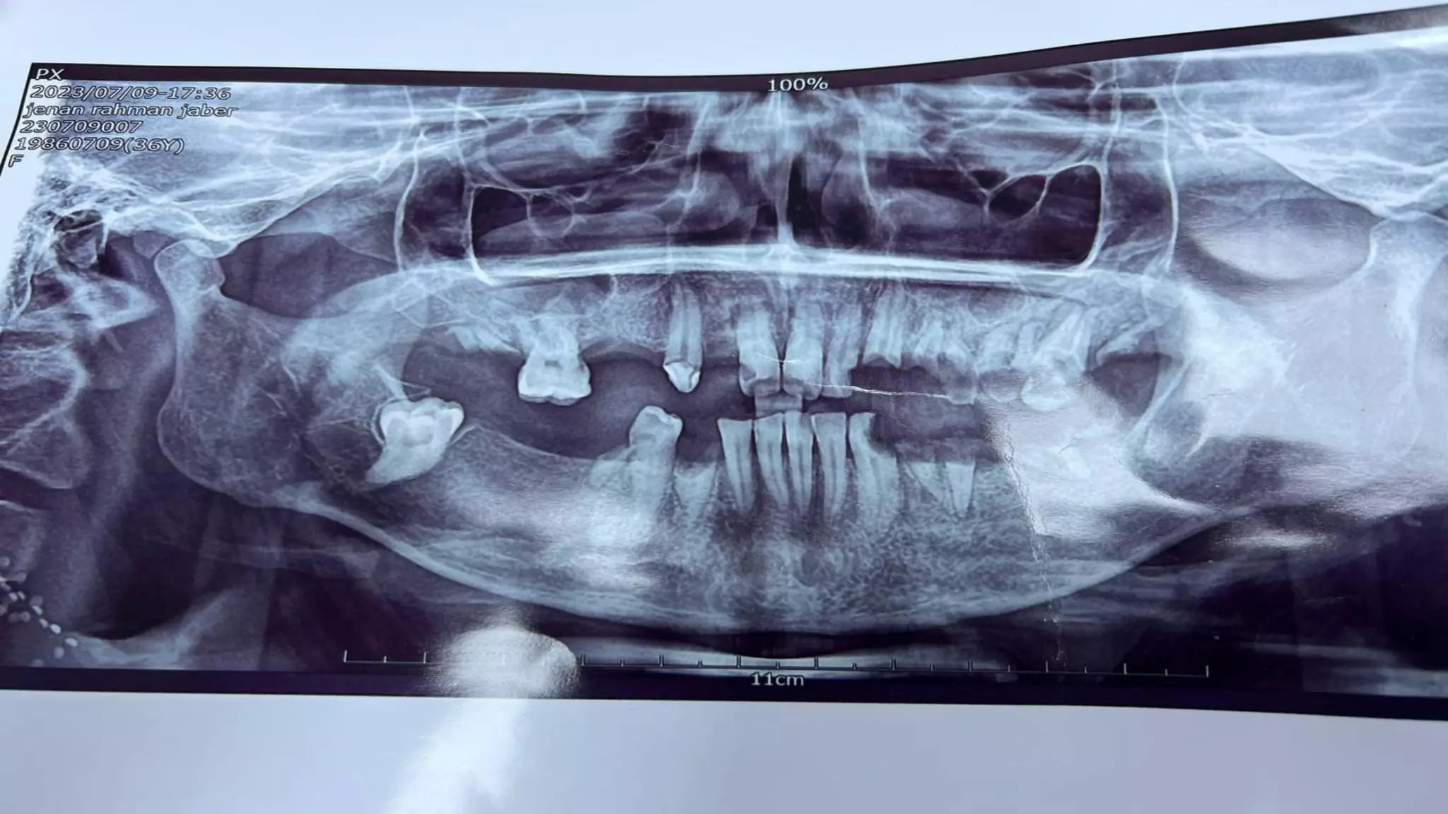 Alveolar Osteitis-DRY SOCKET .pdf