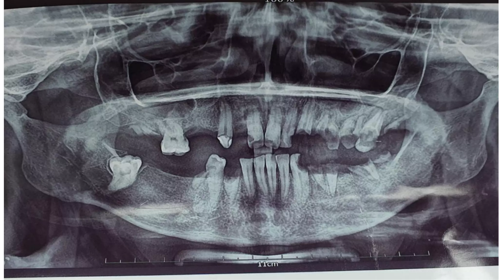 Alveolar Osteitis-DRY SOCKET .pdf