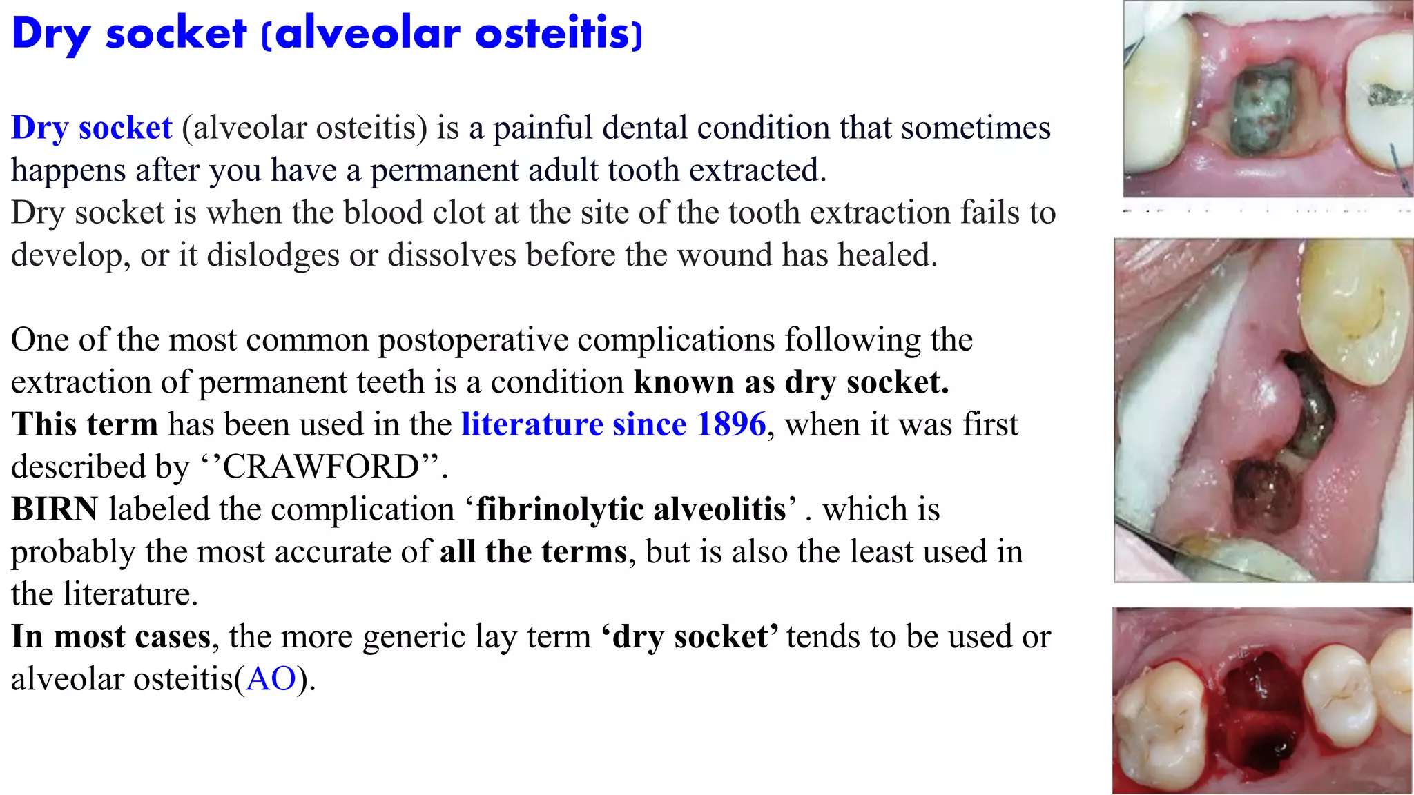 Alveolar Osteitis-DRY SOCKET .pdf