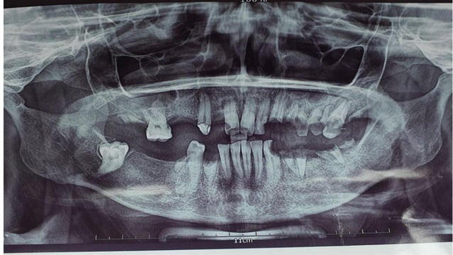 Alveolar Osteitis-DRY SOCKET .pdf