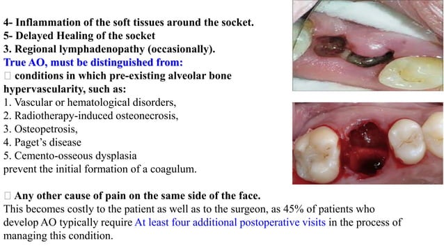 Alveolar Osteitis-DRY SOCKET .pdf