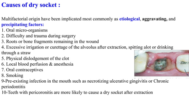 Alveolar Osteitis-DRY SOCKET .pdf