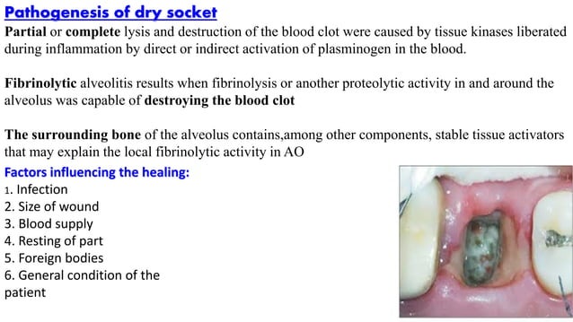 Alveolar Osteitis-DRY SOCKET .pdf