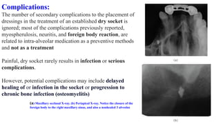 Alveolar Osteitis Radiograph