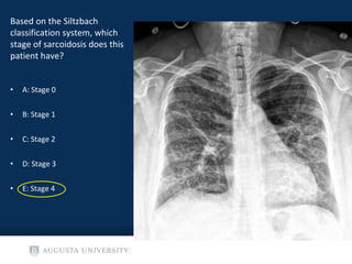 Alveolar sarcoid | PPTX
