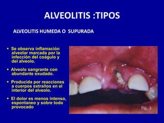 alveolitis_tema.ppt