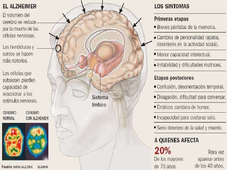 Medicamento cubano para retrasar el Alzheimer en fase de ensayo clínico Medicamento cubano para retrasar el Alzheimer en fase de ensayo clínico