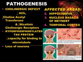 Alzheimer disease | PPT