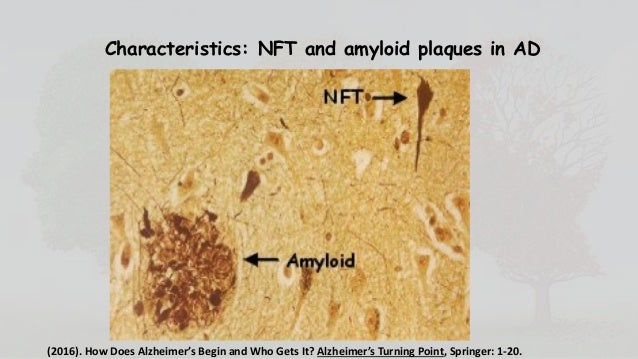 Alzheimer disease