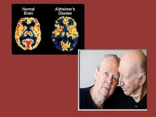 Alzheimer powerpoint | PPTX