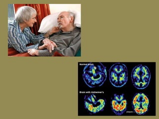 Alzheimer powerpoint | PPTX