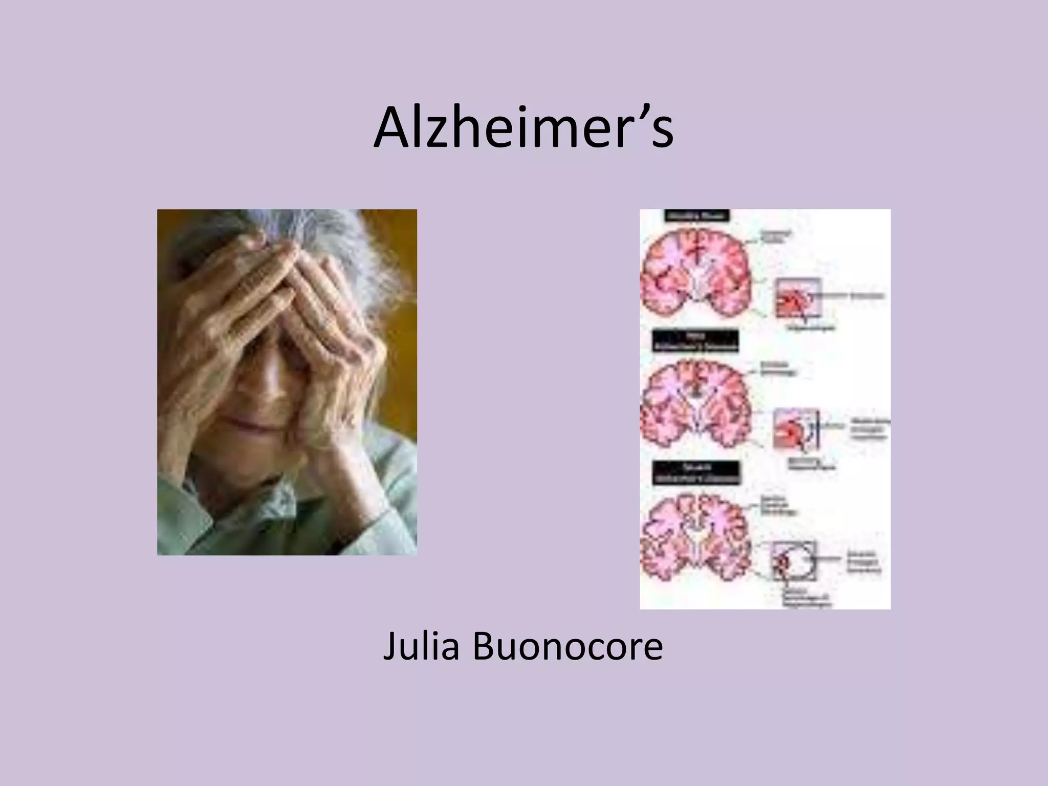 Alzheimers | PPT