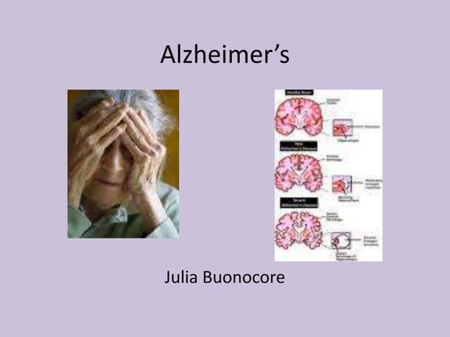 Alzheimers | PPTX