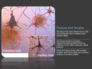 Alzheimer's Dementia vs. Occupational Therapy | PPTX