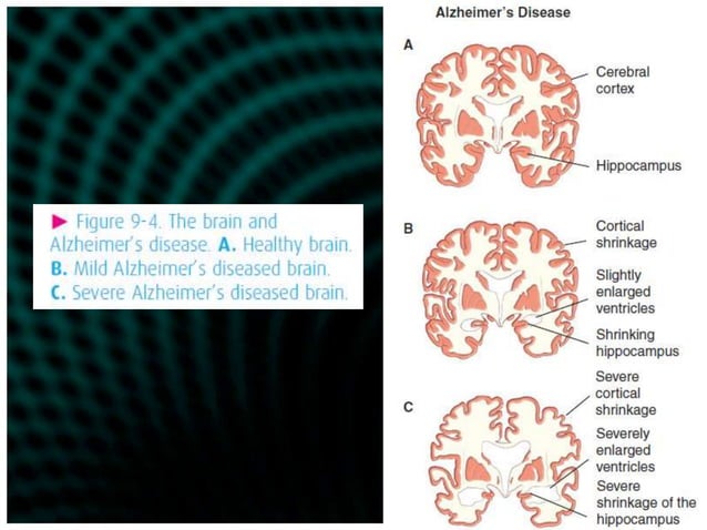 Alzheimer’s disease: Management | PPTX | Brain and Nervous System ...