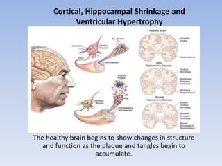 Alzheimer's disease | PPTX