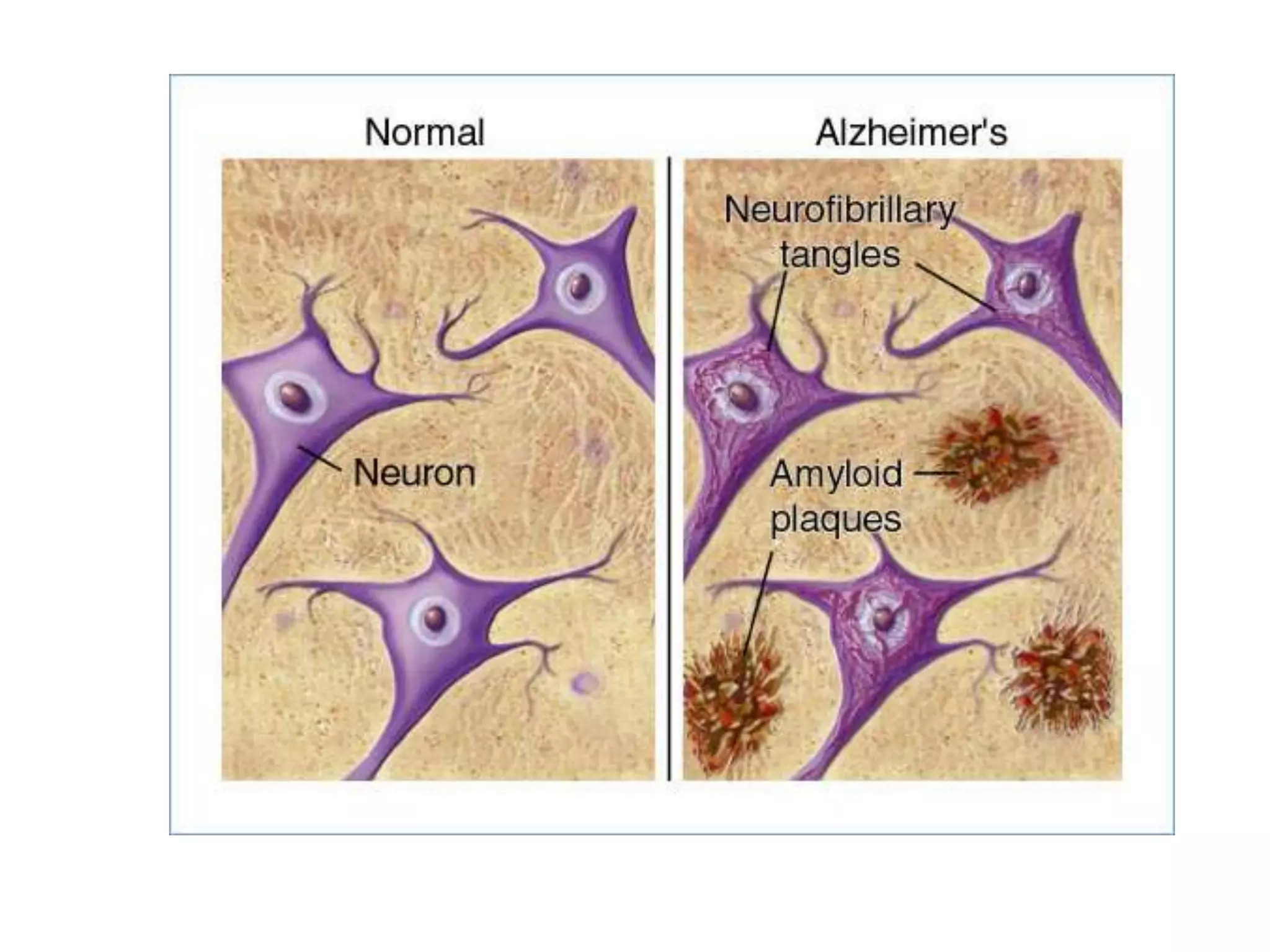 Alzheimer's disease | PPTX