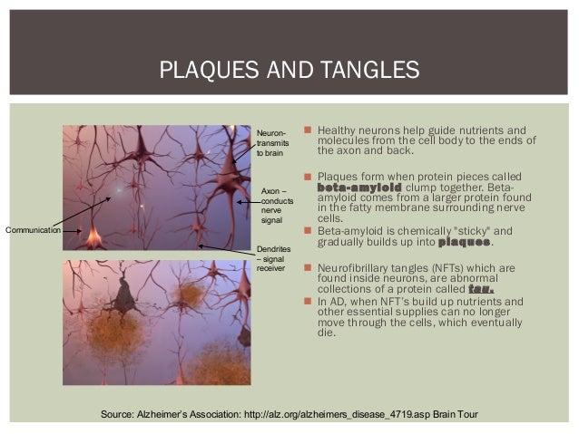 Alzheimer’s disease