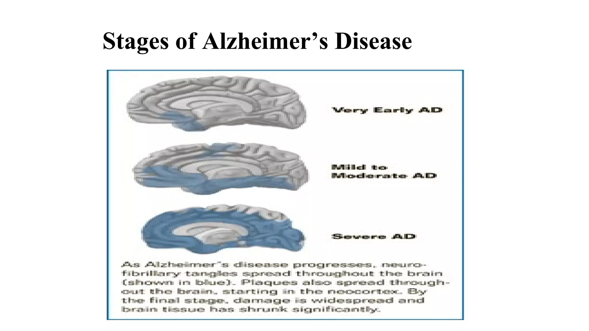 Alzheimer's disease | PPT