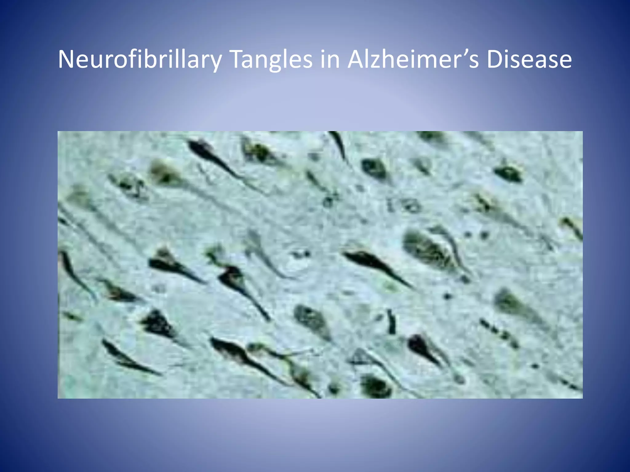 Alzheimer's disease | PPTX