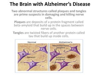 Alzheimer's disease | PPTX