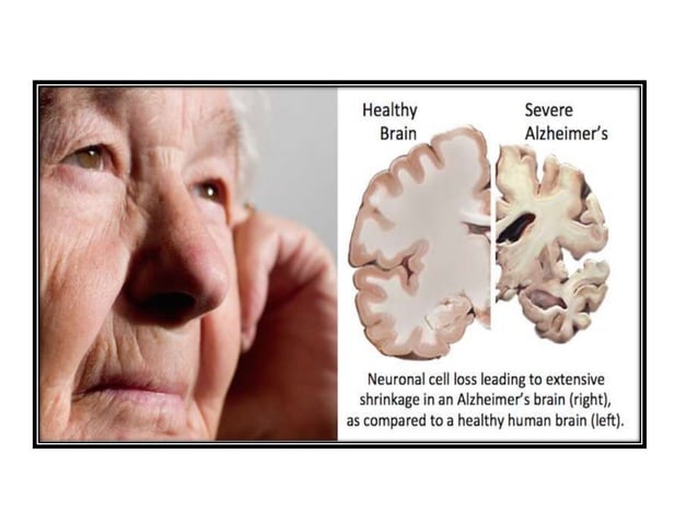 Alzheimer's disease | PPT