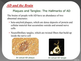 Alzheimers disease | PPT