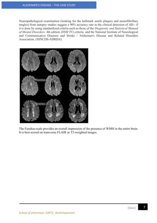 Alzheimer's disease - A detailed case study | PDF