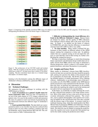 Alzheimer S Disease Brain MRI Classification Challenges And Insights | PDF