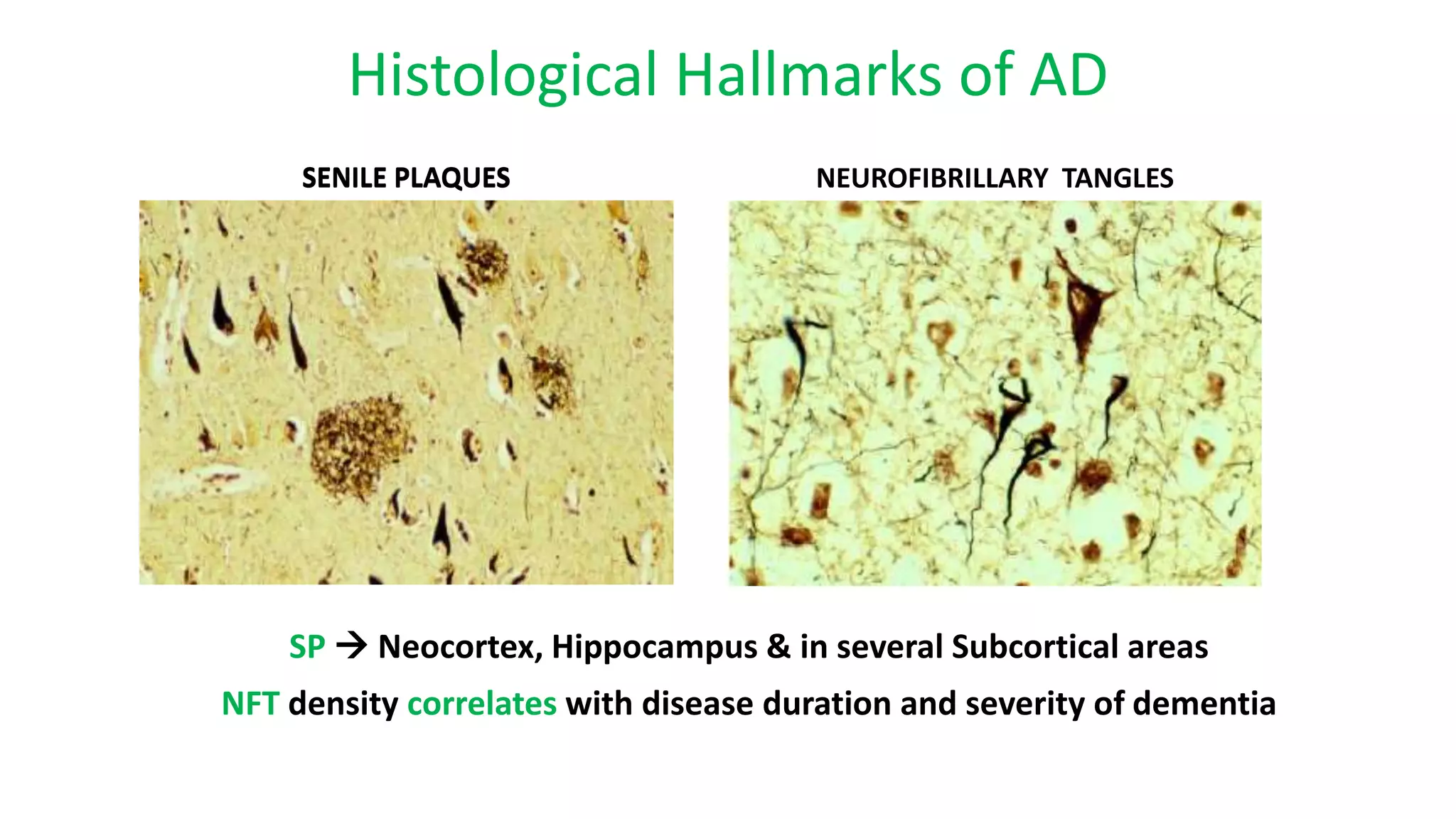 Alzheimer's disease | PPTX